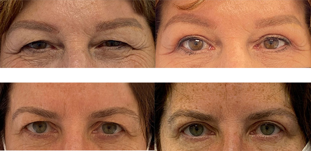 Upper Blepharoplasty | Dr Mahsa Sohrab