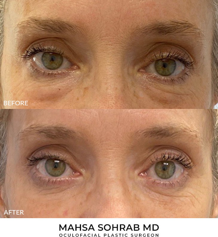 Lower Blepharoplasty Before And After Photo Gallery | Dr Mahsa Sohrab