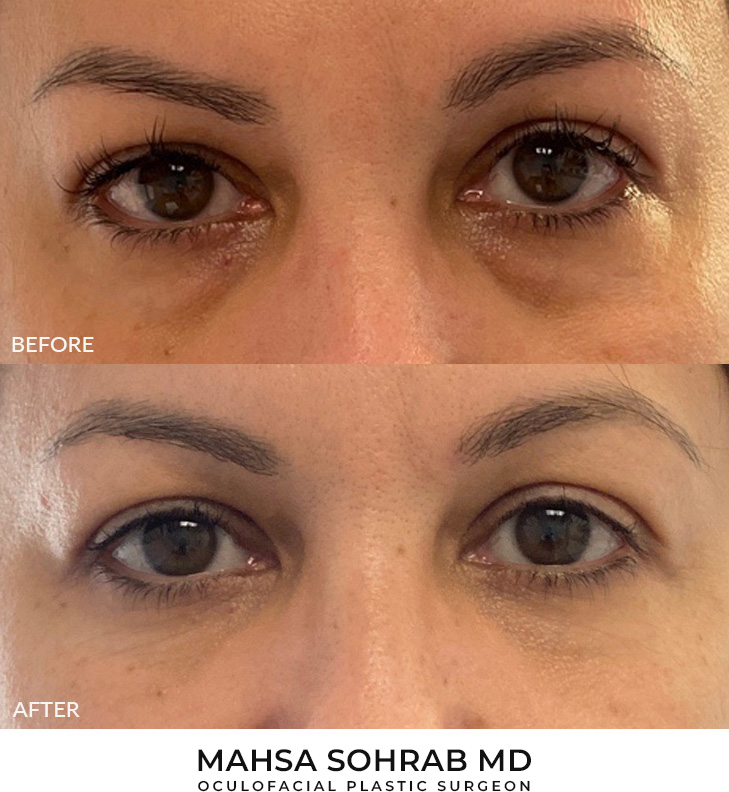 Lower Blepharoplasty Before And After Photo Gallery | Dr Mahsa Sohrab