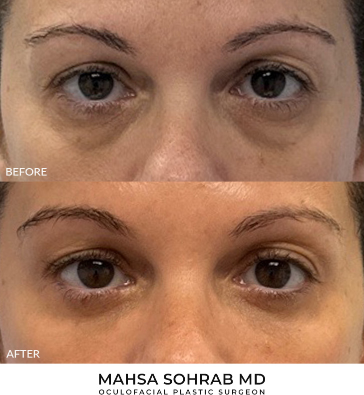 Lower Blepharoplasty Before And After Photo Gallery | Dr Mahsa Sohrab