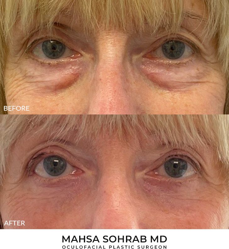 Lower Blepharoplasty Before And After Photo Gallery | Dr Mahsa Sohrab