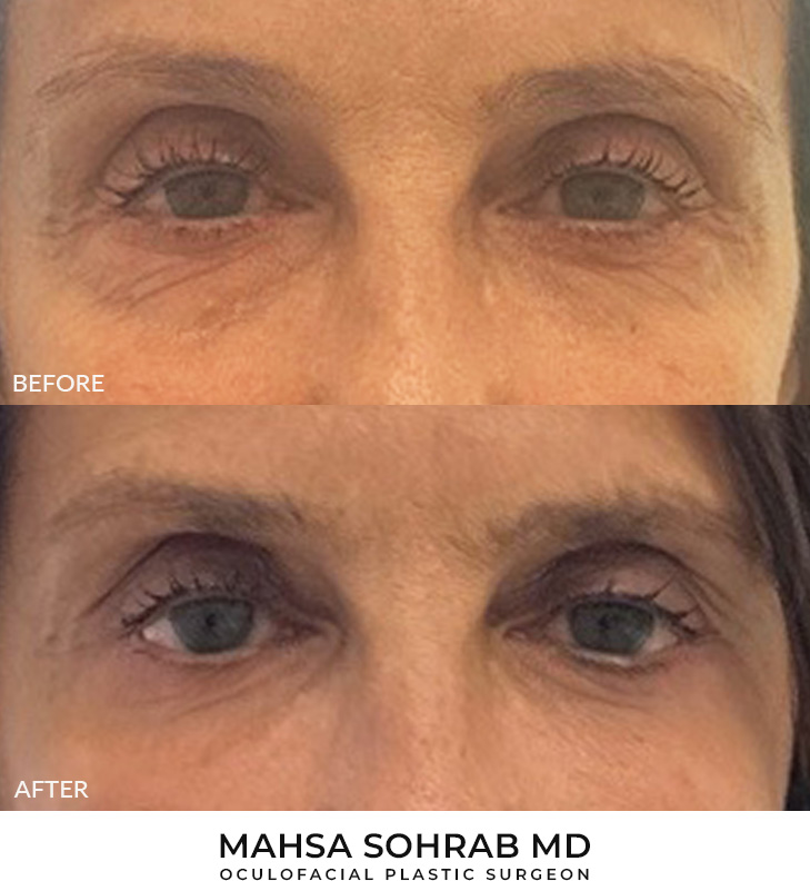 Lower Blepharoplasty Before And After Photo Gallery | Dr Mahsa Sohrab